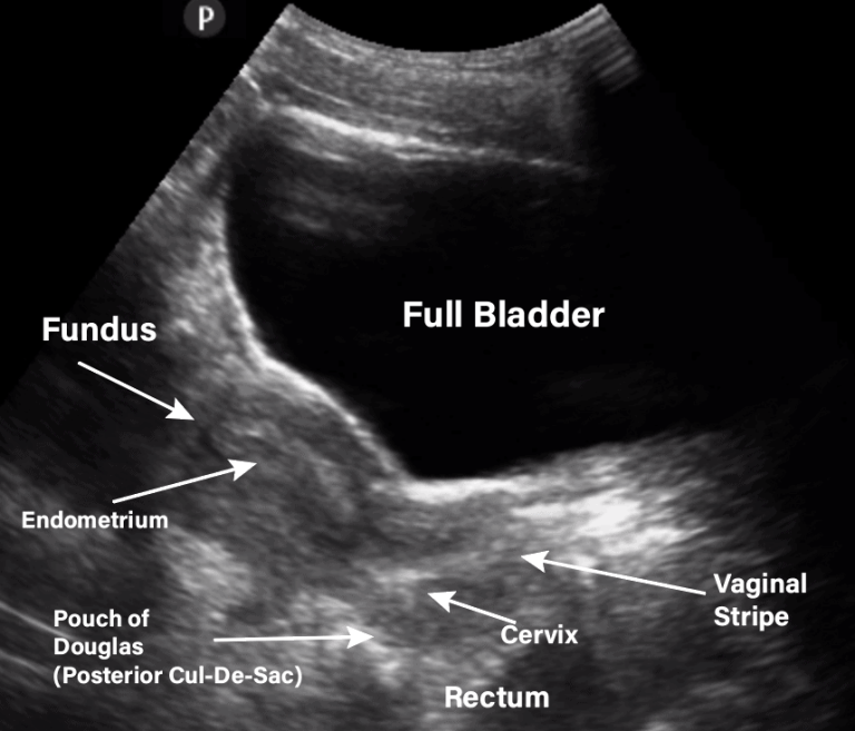 Pelvic Ultrasound: A Non-Invasive Imaging Tool for Female Health