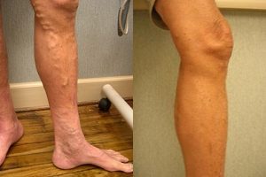 Dealing with Achy Legs: Causes, Remedies, and Prevention Tips