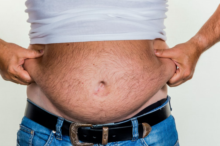 Understanding Apron Belly: Causes, Effects, and Ways to Manage