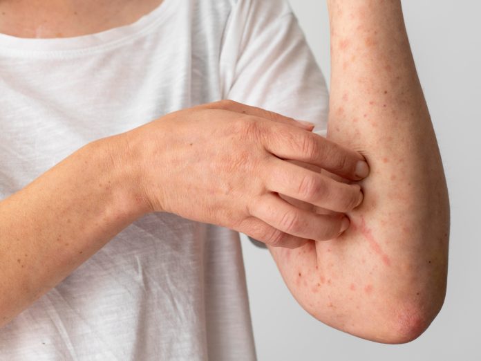 Atopy Uncovered: Exploring Allergic Skin Conditions and Solutions