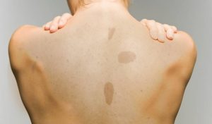 Café au Lait Spots: Causes, Appearance, and Treatment