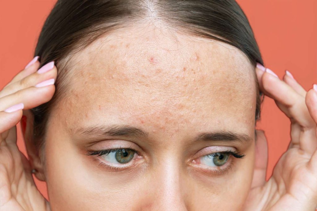 Comedonal Acne: Causes, Treatment, and Prevention Strategies