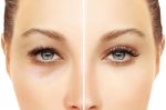 Transform Your Look with an Eye Lift: What You Need to Know