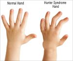 Hunter Syndrome: the Genetics, Symptoms, and Treatments
