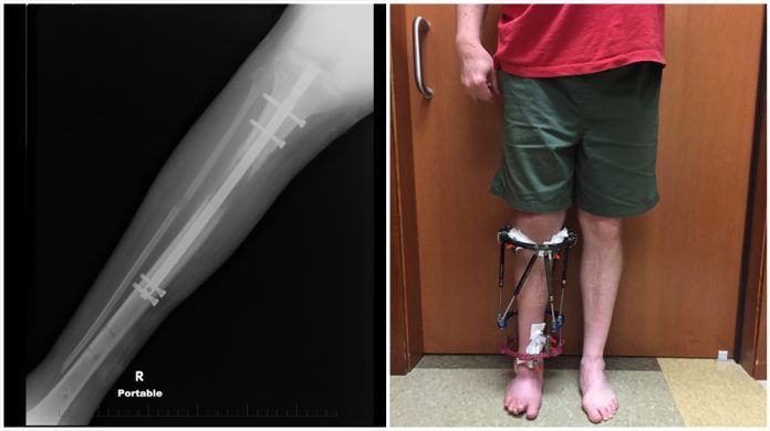 Exploring the World of Limb Lengthening Surgery and Its Impact