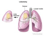 Lobectomy: Surgery, Recovery, and Life After