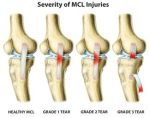 MCL Sprain: Causes, Symptoms, and Recovery