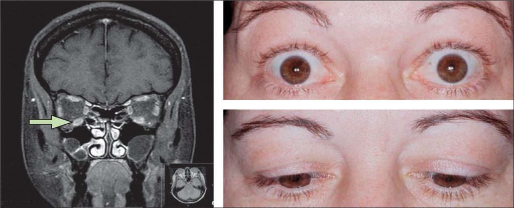 Miller Fisher Syndrome: Symptoms, Diagnosis, and Treatment