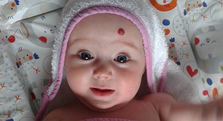 Strawberry Birthmarks: Causes, Types, and Treatment