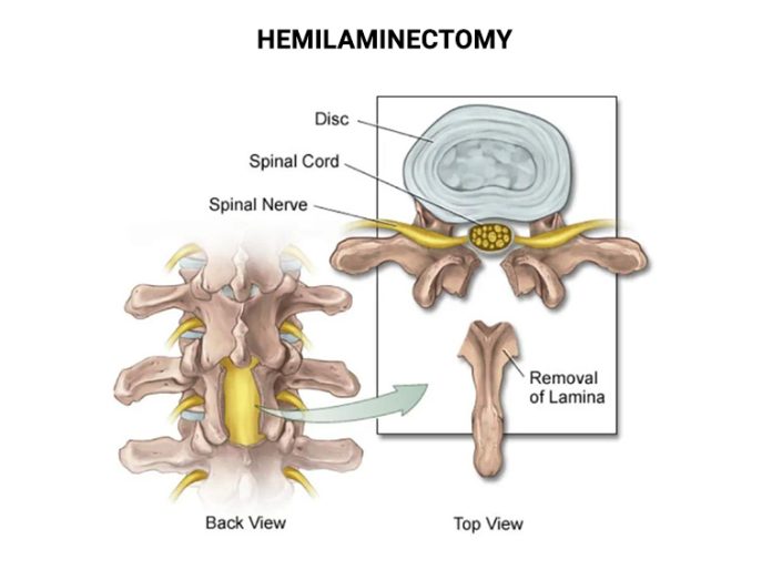 Hemilaminotomy: A Comprehensive Guide to the Spinal Procedure