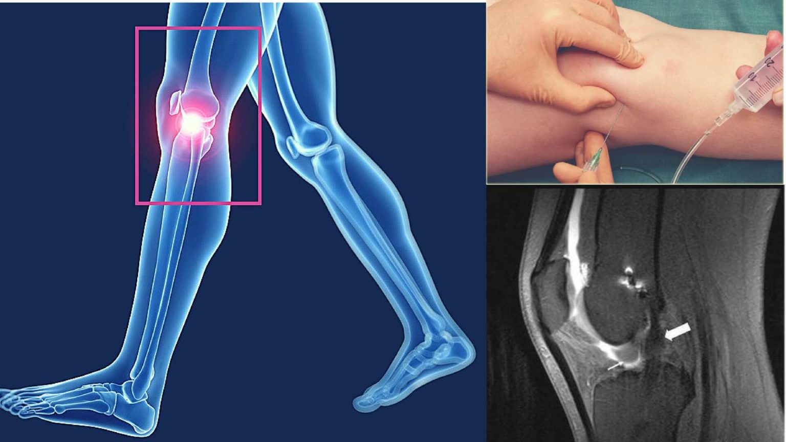 Demystifying Arthrograms: What You Need to Know