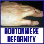 Boutonniere Deformity: Causes, Symptoms, and Solutions