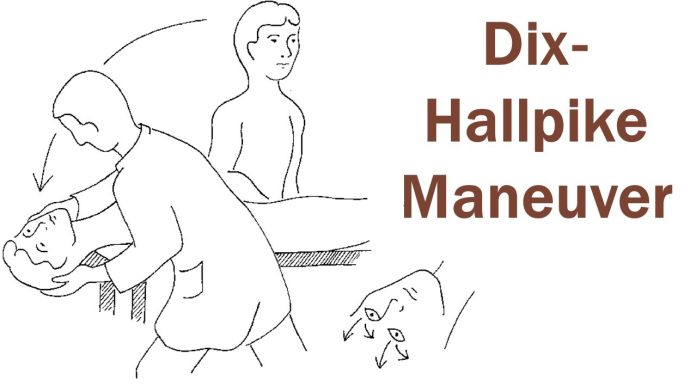 Dix Hallpike the Vertigo Test for Balance Disorders