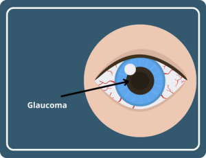 Navigating Glaucoma Surgery: A Comprehensive Guide