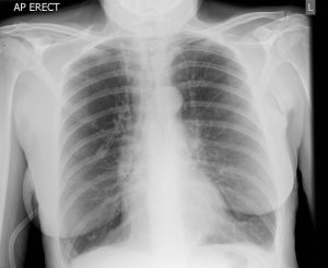 Hyperinflation of Lungs: Causes, Symptoms, and Treatment
