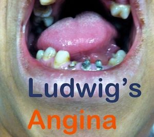 Ludwig's Angina Causes, Symptoms, and Treatment Options