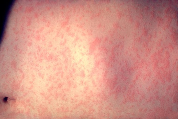 The Maculopapular Rash Causes, Symptoms, and Treatment