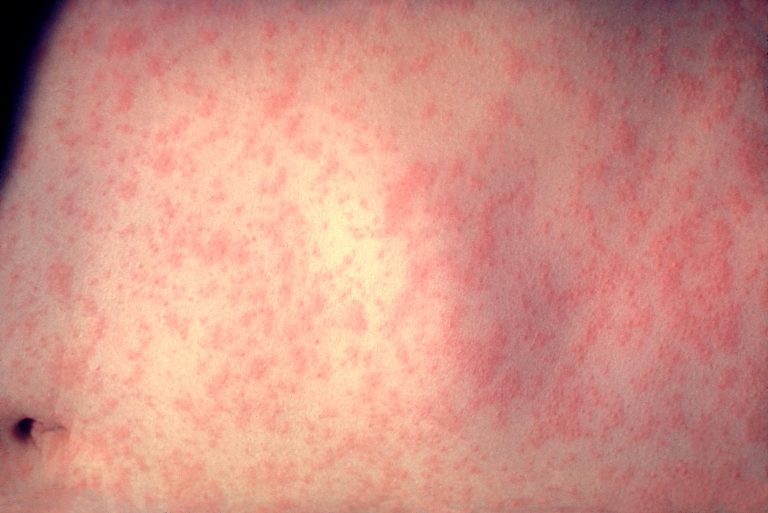 The Maculopapular Rash Causes, Symptoms, and Treatment