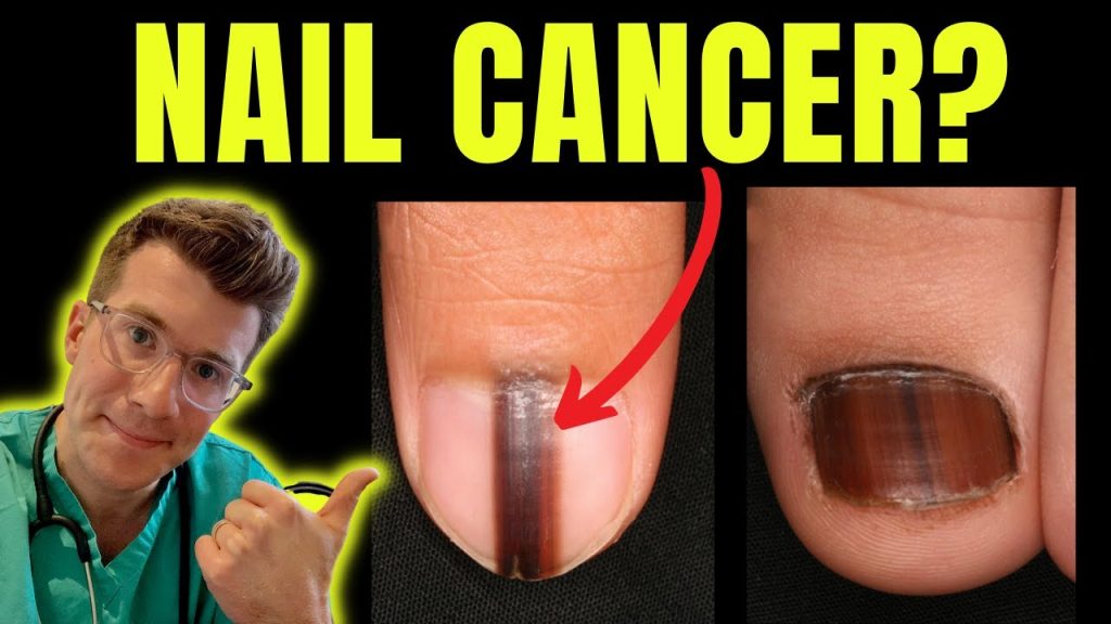 Nail Cancer: Detection, Causes, and Protection