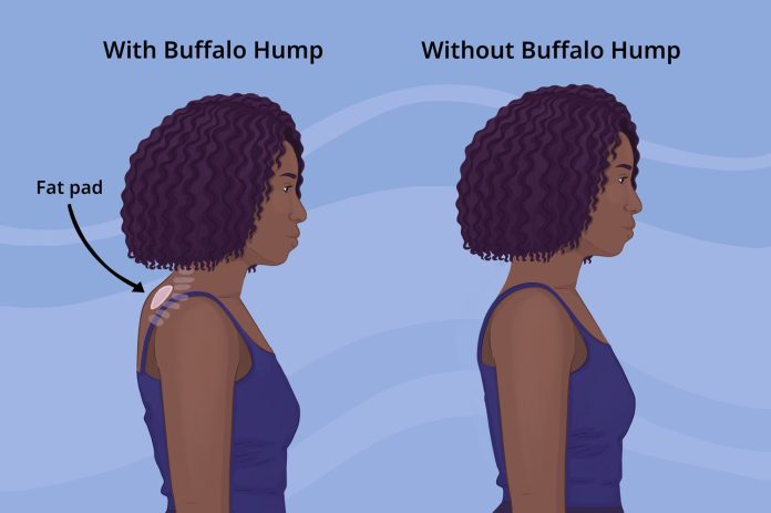Neck Hump Causes, Prevention, and Solutions