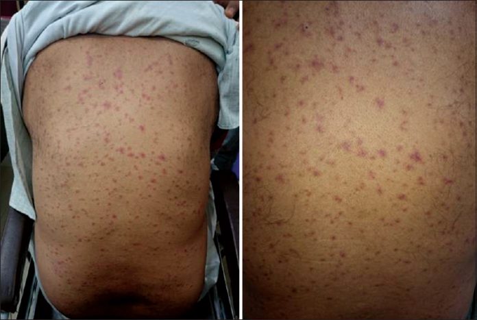 Navigating Oxcarbazepine Side Effects What You Need to Know