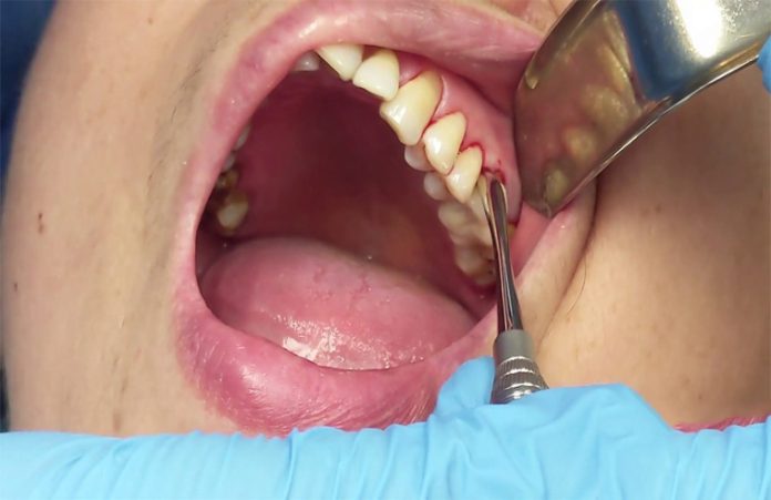 The Art of Pulling Teeth
