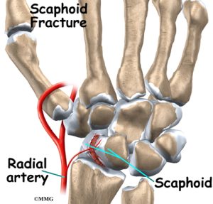 Scaphoid Fractures Causes, Symptoms, and Treatment