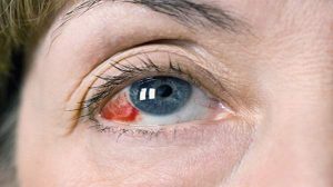 Stroke in the Eye Causes, Symptoms, and Treatment