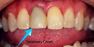 Temporary Crown Your Guide to Dental Restorations