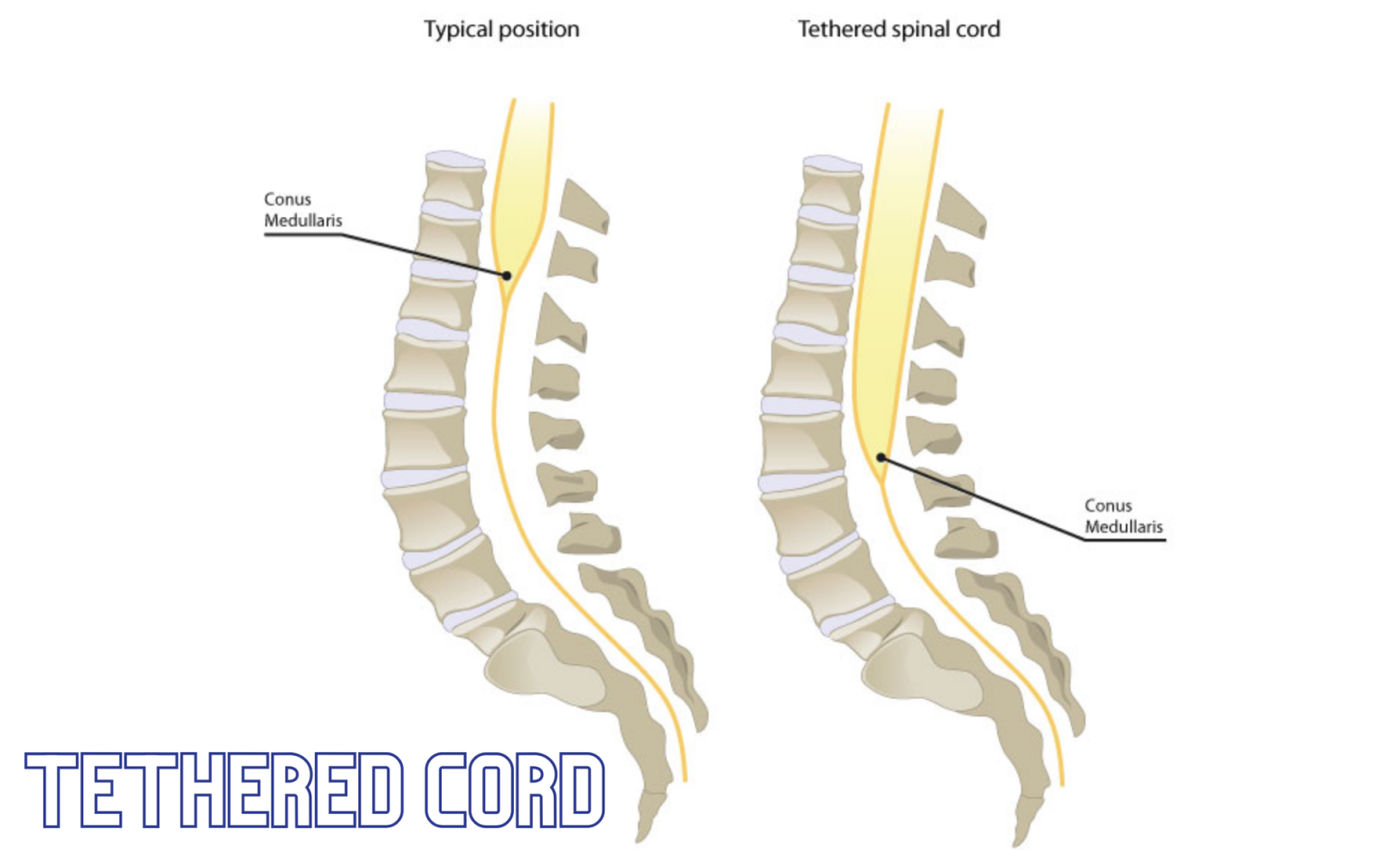 Tethered Cord Syndrome: Causes, Symptoms, and Treatment