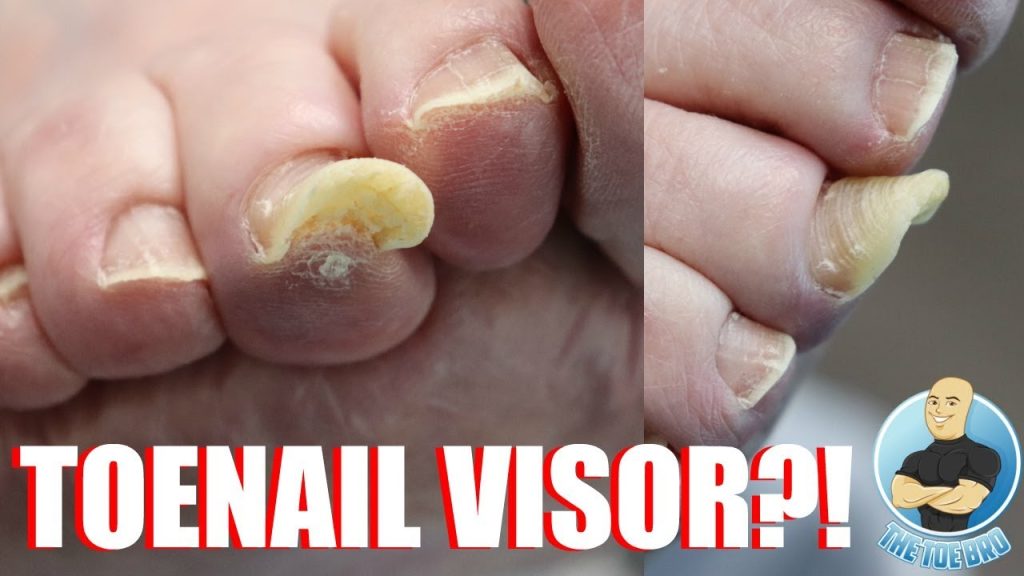 Thick Toenails Causes, Treatments, and Prevention
