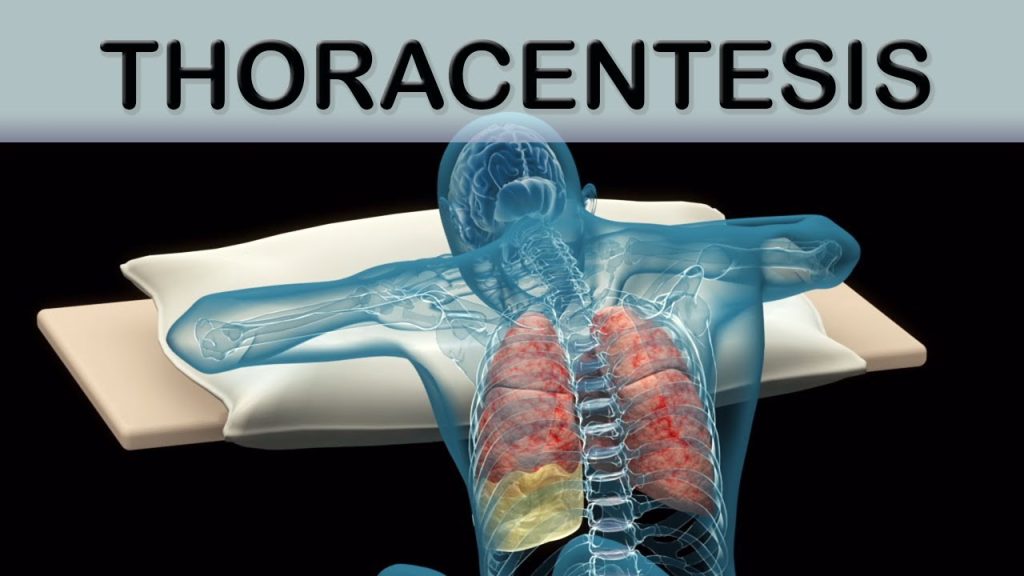 Thoracentesis: A Closer Look at the Thoracentesis Procedure