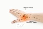 Thumb Arthritis: Causes, Symptoms, and Treatment