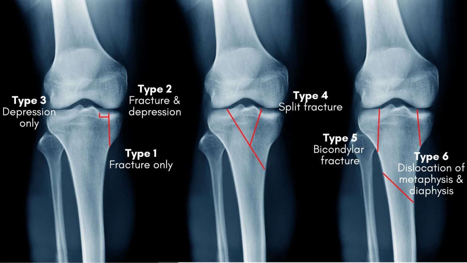 Tibial Plateau Fracture Causes, Symptoms, and Treatment
