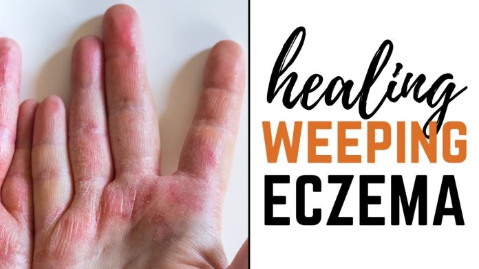 Dealing with Weeping Eczema: Causes, Symptoms, and Solutions