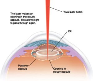 Precision the Power of YAG Laser